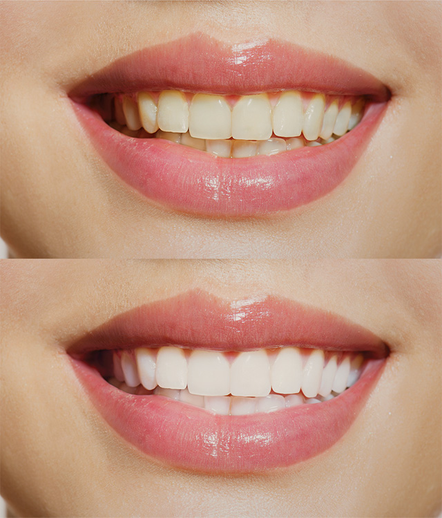 Teeth Whitening Dentist Calgary - Toothworks Calgary, AB
